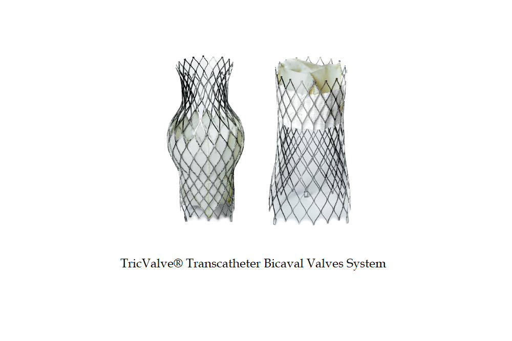 TRICVALVE®: Transcatheter Bicaval Valves System granted Designation as ...